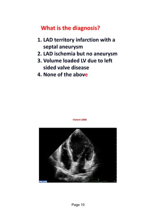 Echo in ischaemic heart disease and Myocardial infarction | PDF