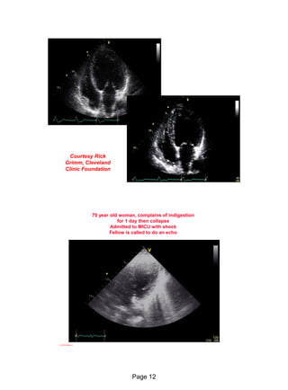 Echo in ischaemic heart disease and Myocardial infarction | PDF