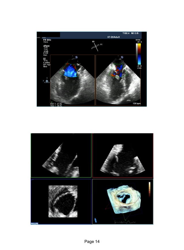 Echo in ischaemic heart disease and Myocardial infarction | PDF