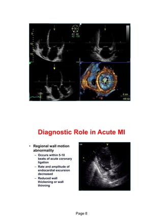 Echo in ischaemic heart disease and Myocardial infarction | PDF