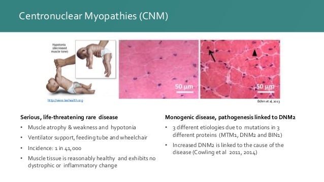 ASO-mediated DNM2 knockdown for Centronuclear Myopathies