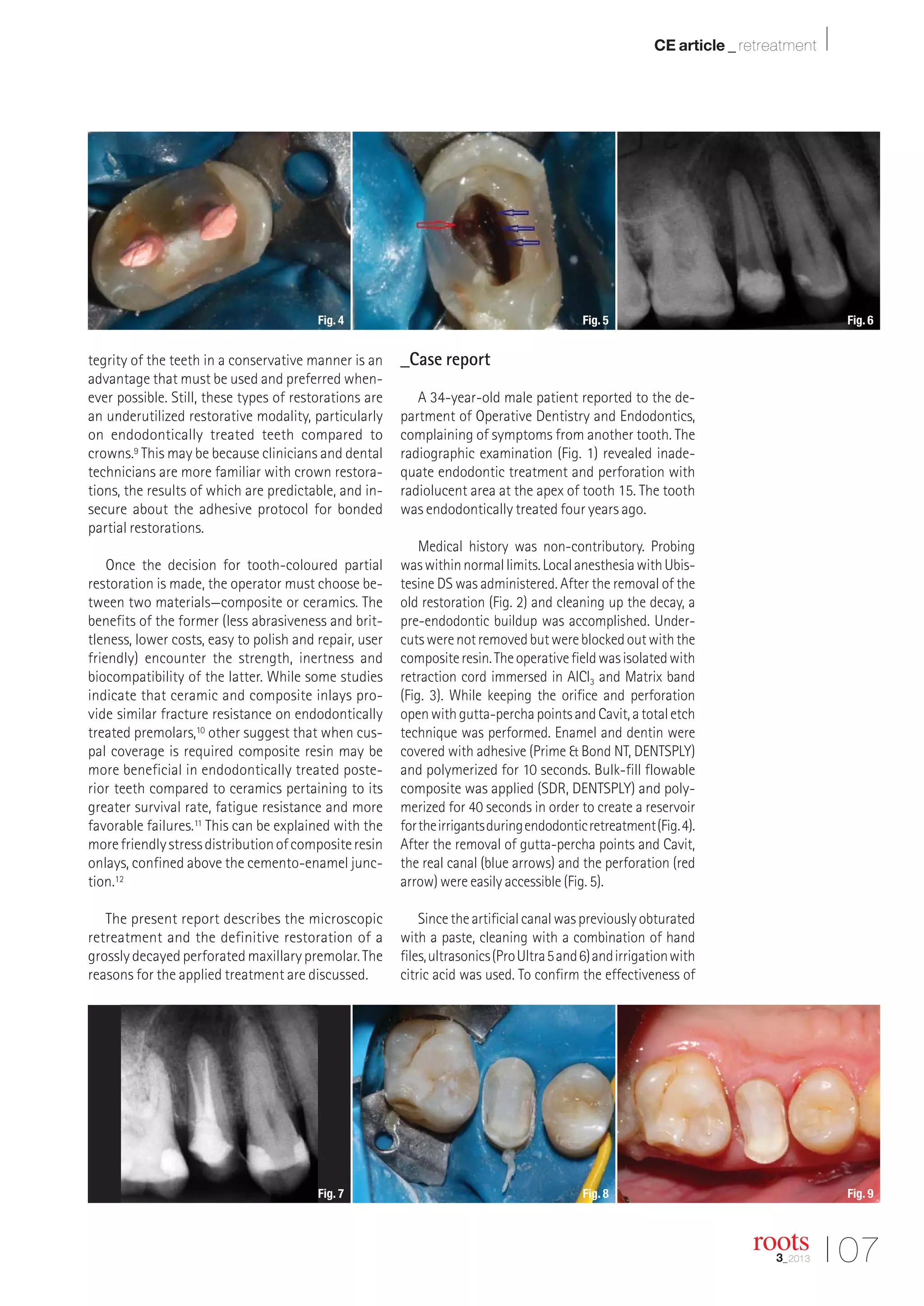 Eight-year follow-up of successful intentional replantation | PDF