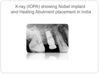 Authorized center for noble biocare implants | PPTX