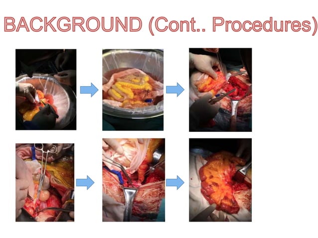 Auto-intestine transplant for Pancreatic Cancer.ppt