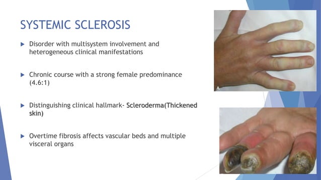 Autoantibody testing in CTD.pptx | Blood Disorders | Diseases and ...