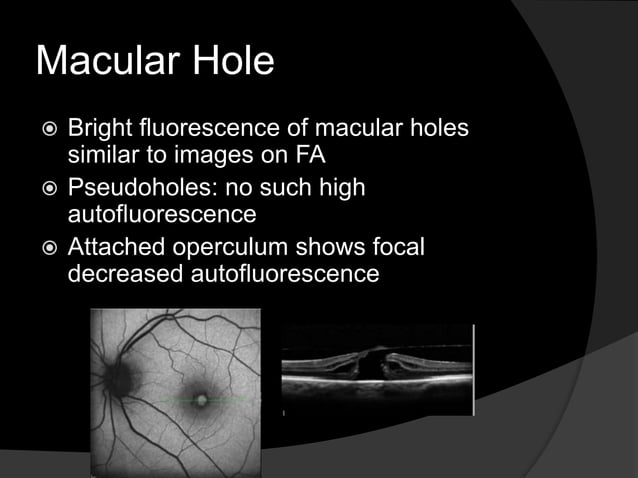 Autofluorescence | PPTX | Eye and Vision Conditions | Diseases and ...