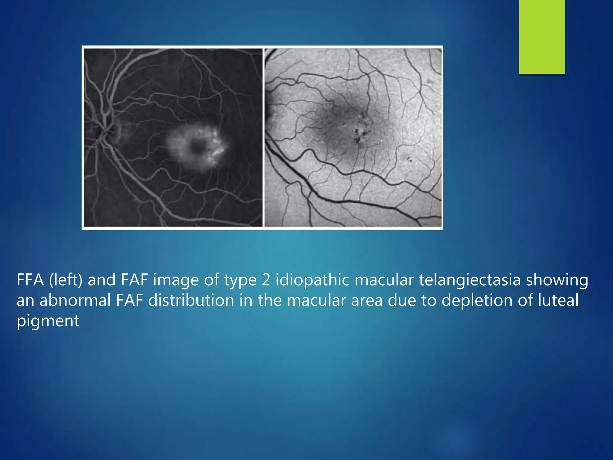 FUNDUS AUTOFLUORESCENCE | PPTX