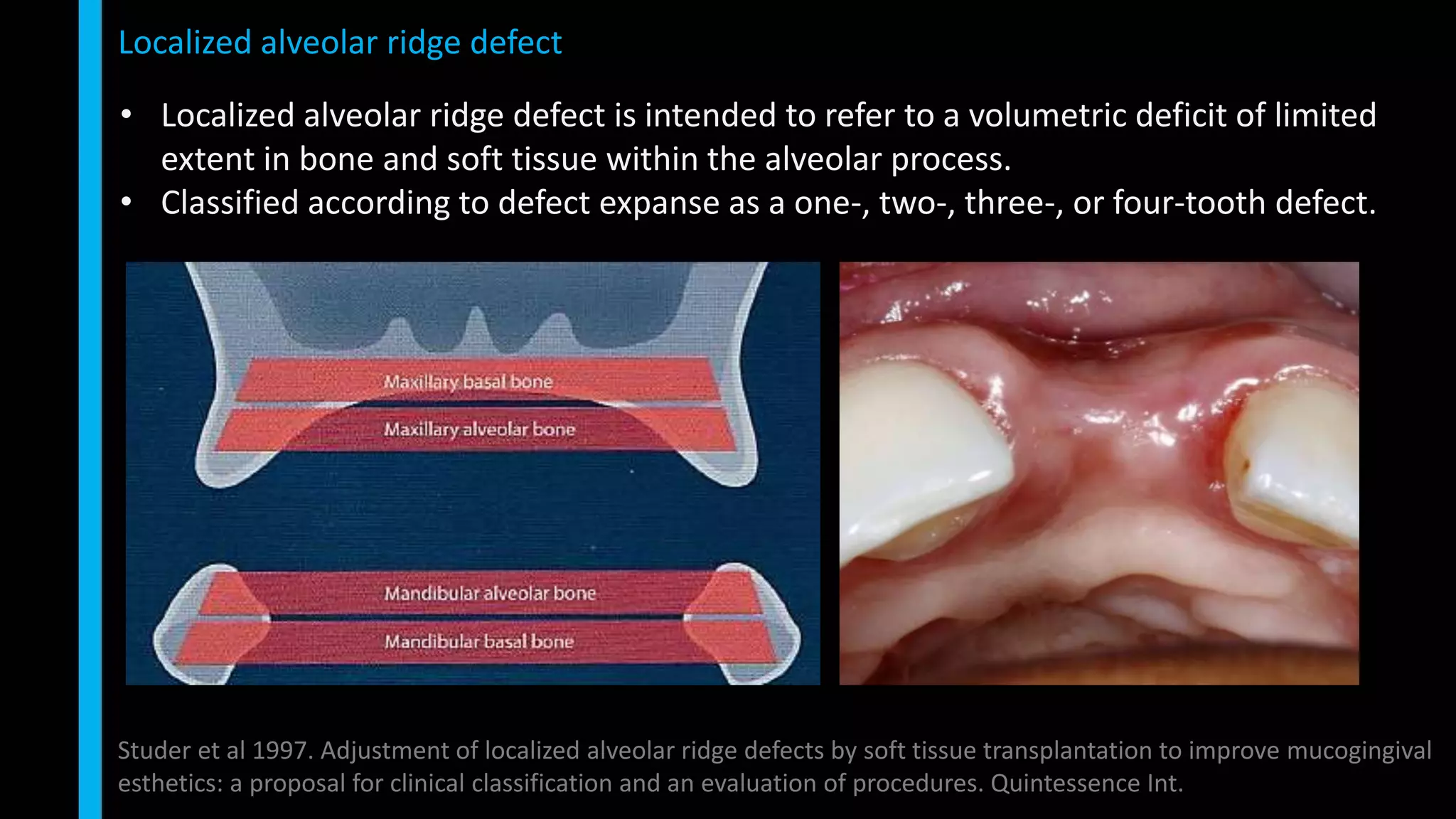Autogenous bone graft harvesting | PPTX
