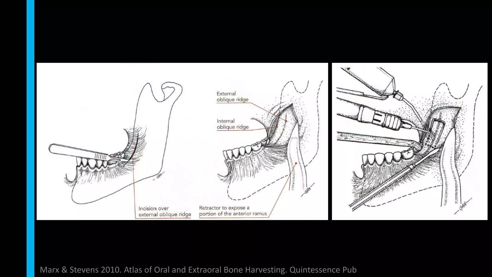 Autogenous bone graft harvesting | PPTX | Bone and Joint Conditions ...