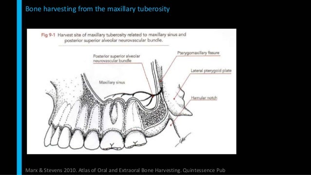 Autogenous bone graft harvesting