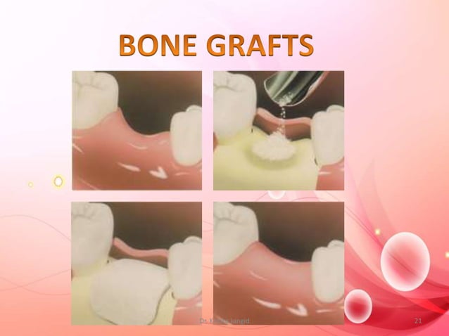Autogenous bone grafting | PPT