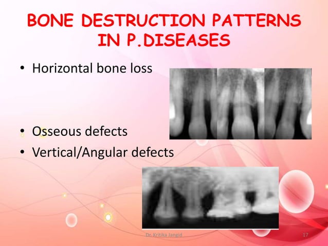 Autogenous bone grafting | PPT