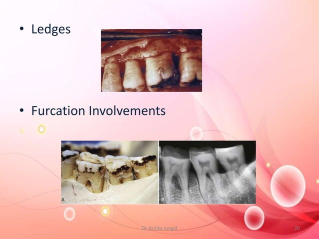 Autogenous bone grafting | PPT