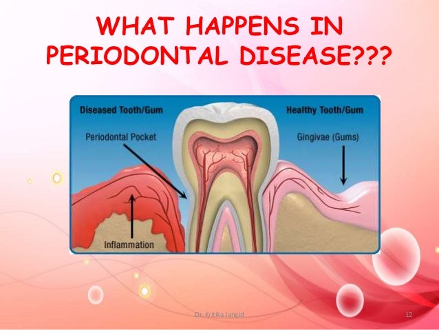 Autogenous bone grafting