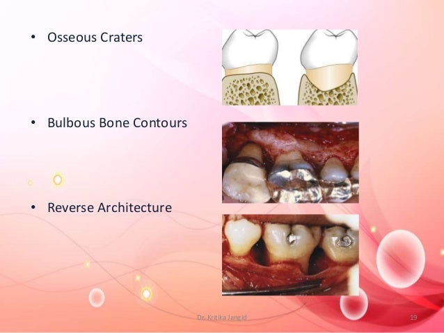 Autogenous bone grafting