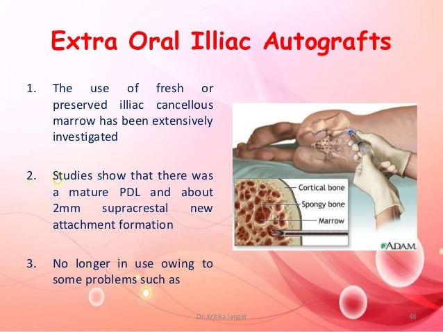 Autogenous bone grafting