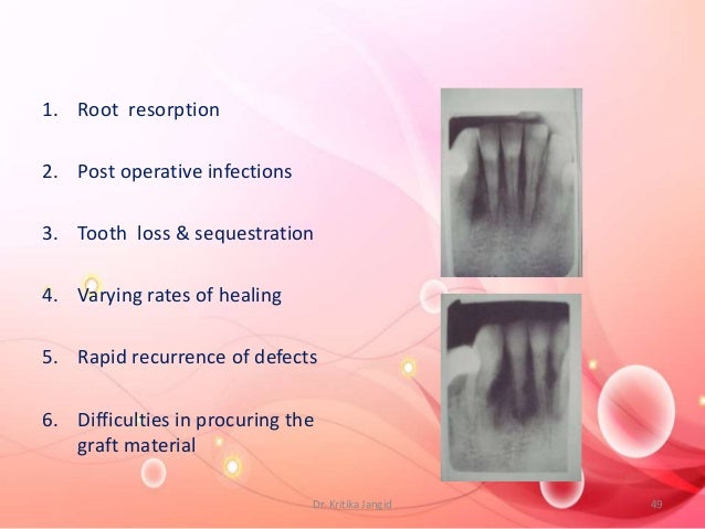 Autogenous bone grafting