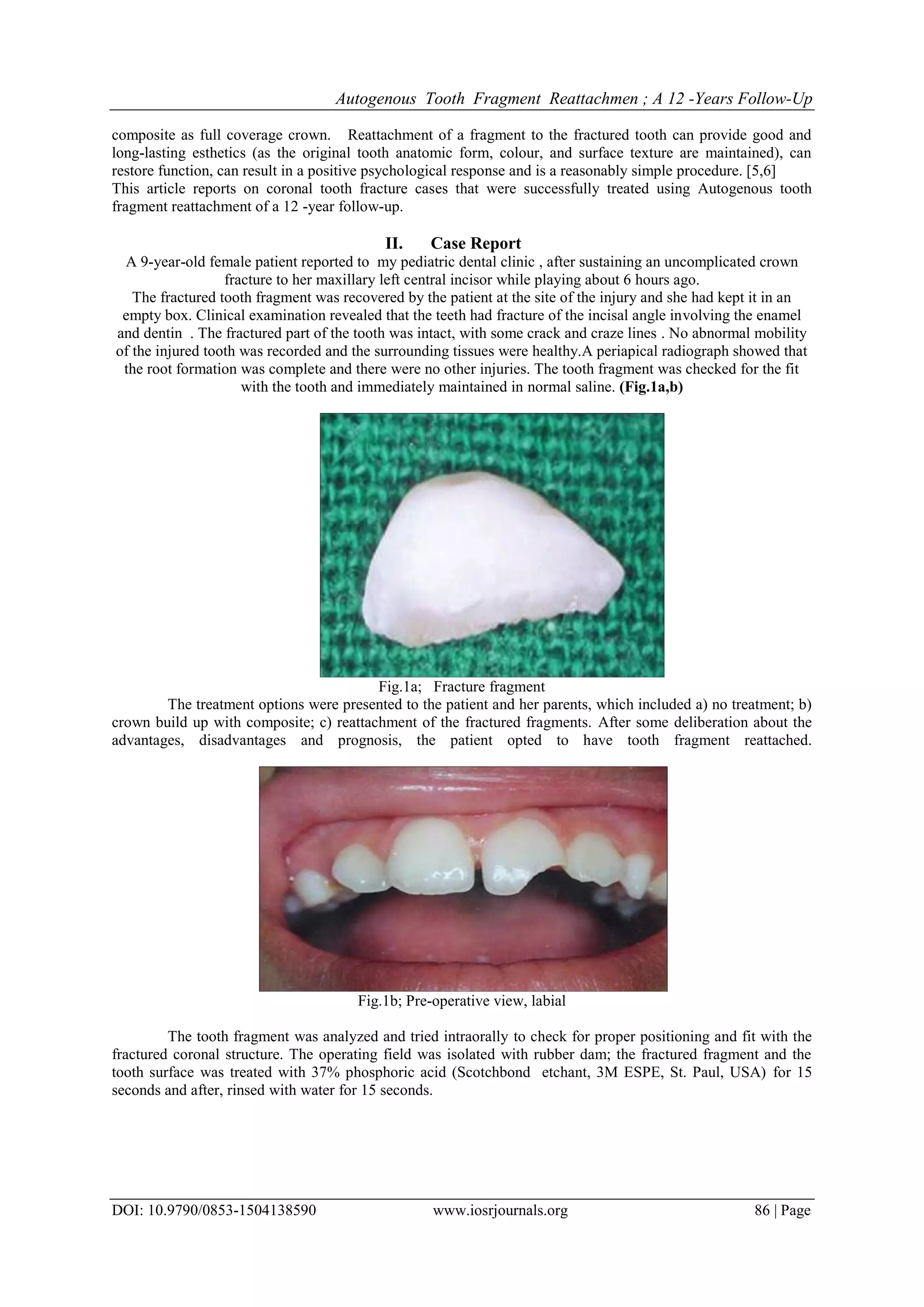 Autogenous tooth fragment reattachment ; a 12 years follow-up | PDF ...