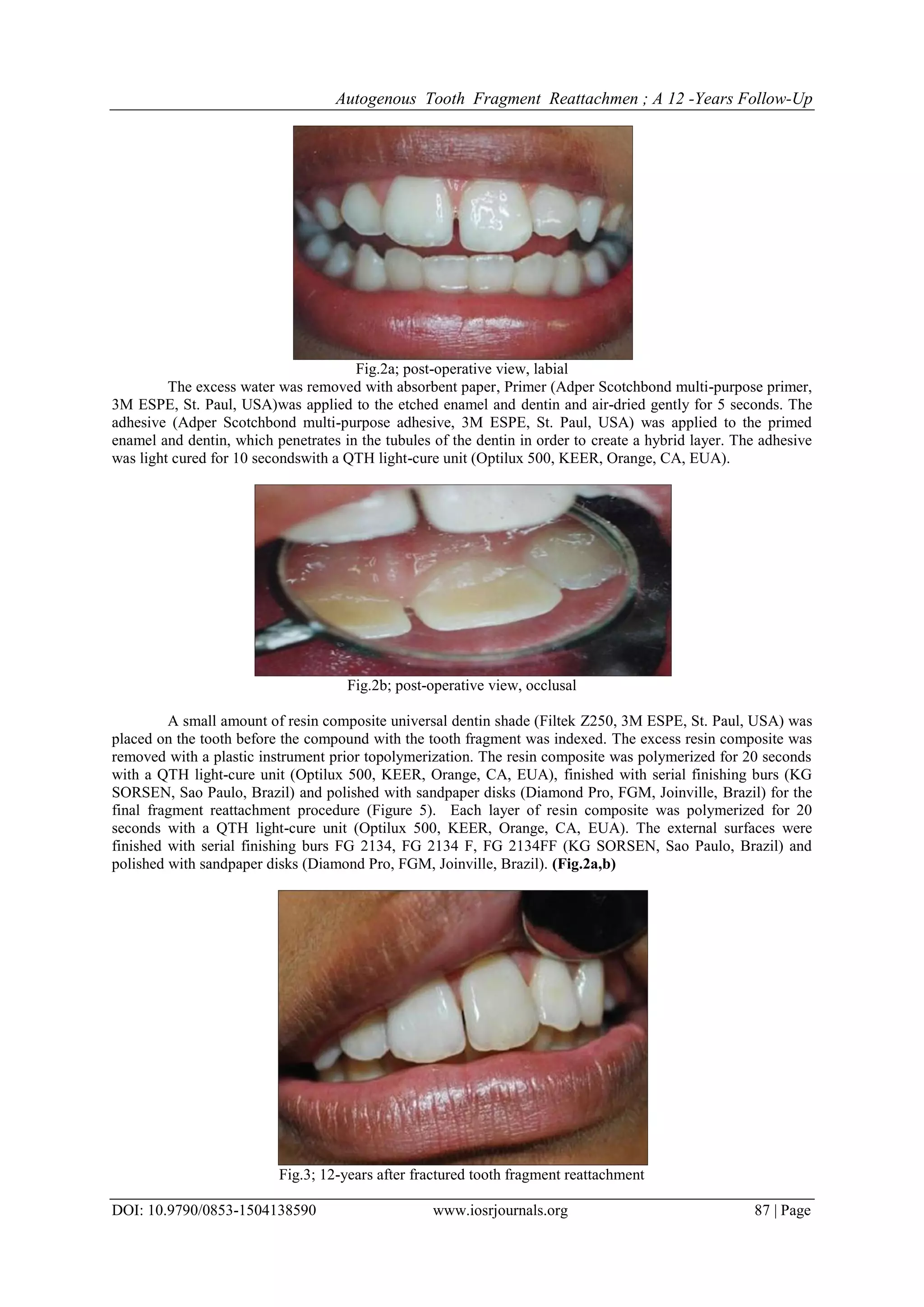 Autogenous tooth fragment reattachment ; a 12 years follow-up | PDF