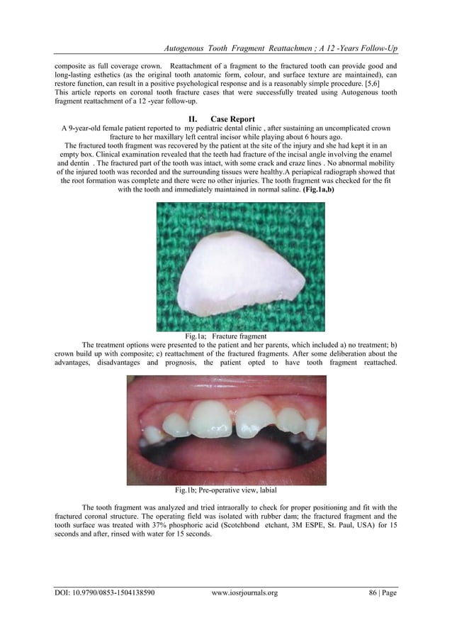 Autogenous tooth fragment reattachment ; a 12 years follow-up | PDF ...