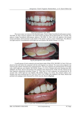 Autogenous tooth fragment reattachment ; a 12 years follow-up | PDF