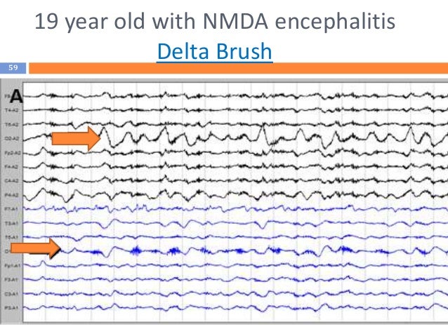 Lab diagnosis of Autoimmune Encephalitis