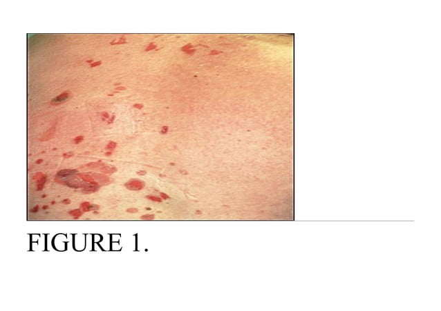 Autoimmune bullous dermatoses | DOC