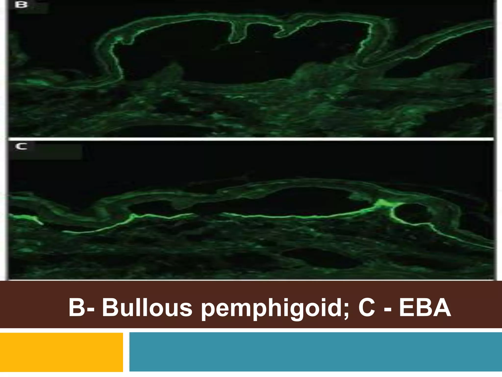 Autoimmune bullous lesions of skin | PPTX