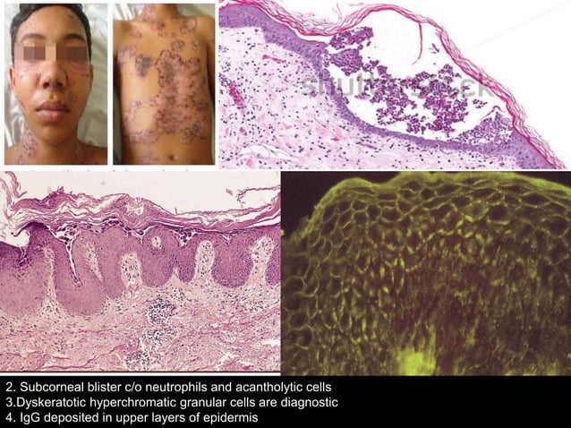 Autoimmune bullous lesions of skin | PPTX | Skin and Dermatology ...
