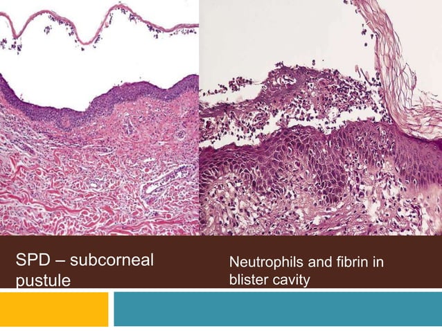Autoimmune bullous lesions of skin | PPTX | Skin and Dermatology ...