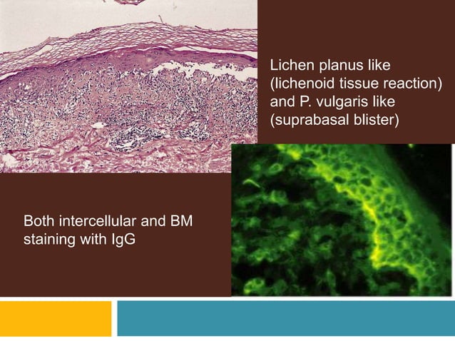 Autoimmune bullous lesions of skin | PPTX | Skin and Dermatology ...