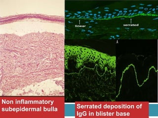Autoimmune bullous lesions of skin | PPTX