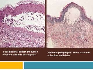 Autoimmune bullous lesions of skin | PPTX