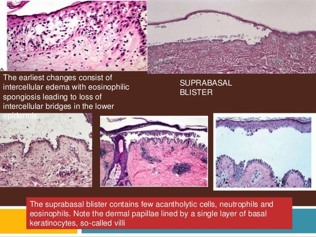 Autoimmune bullous lesions of skin