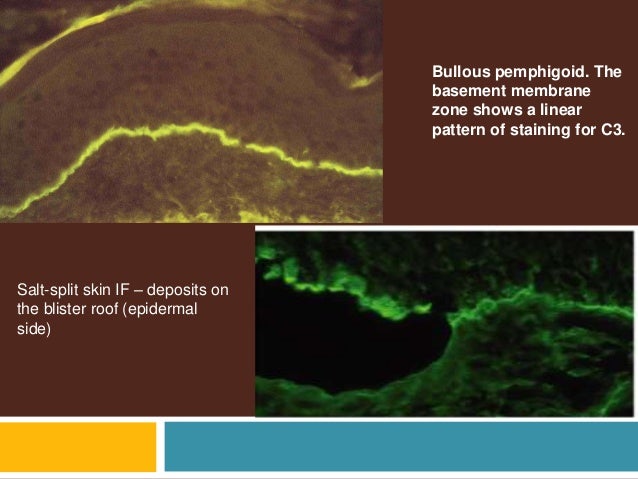 Autoimmune bullous lesions of skin