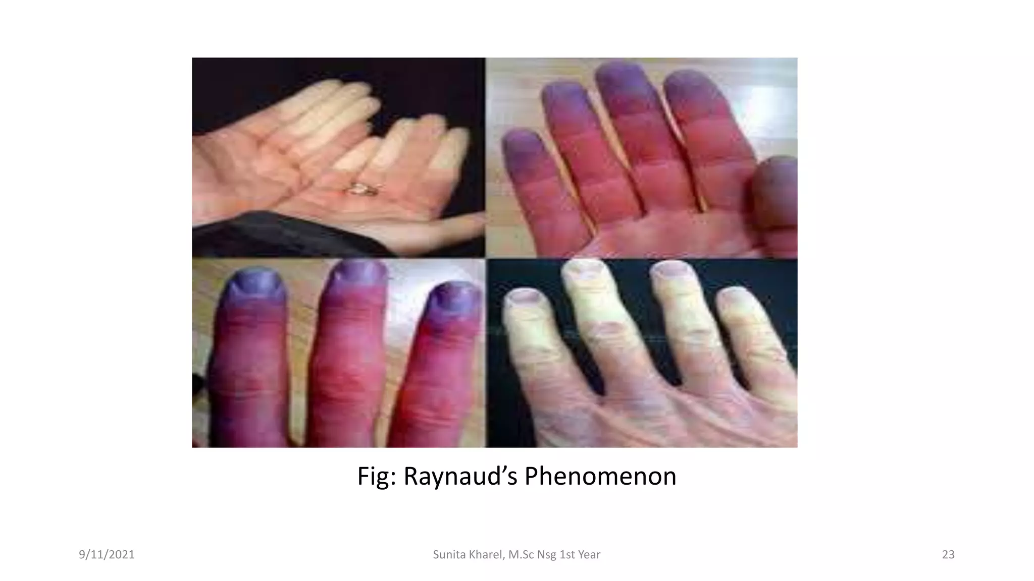 Autoimmune disease of bone | PPT