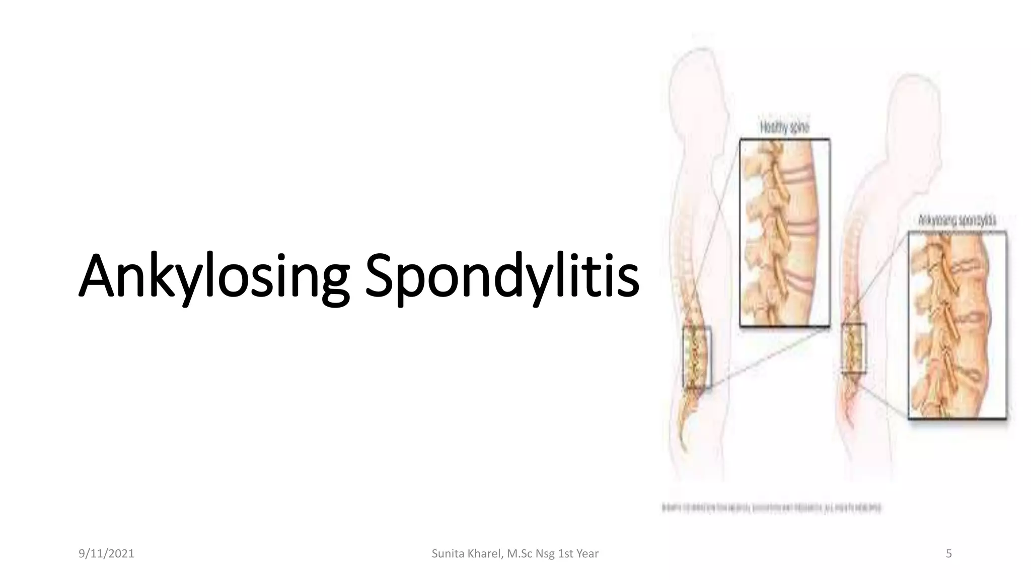 Autoimmune disease of bone | PPT
