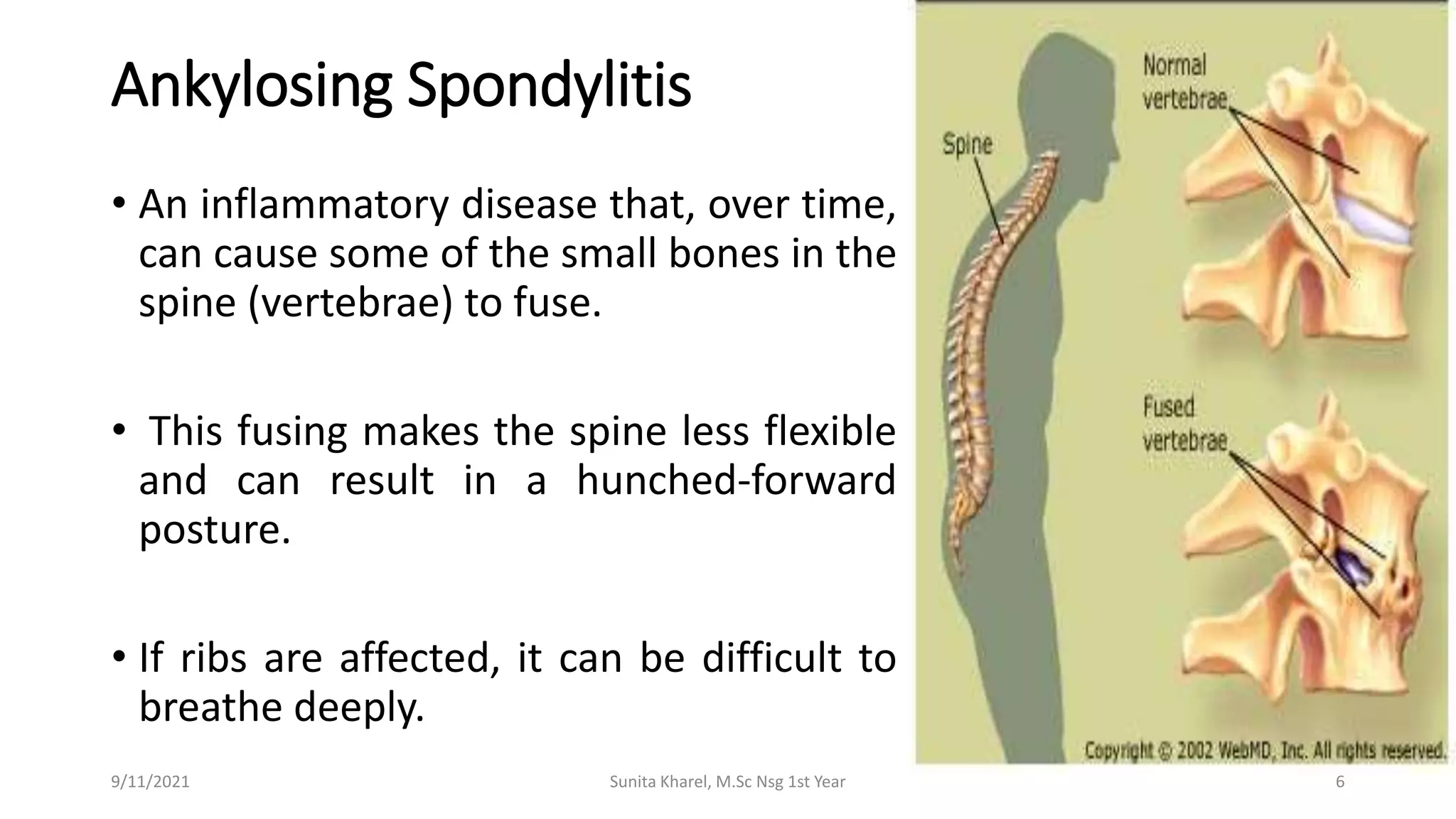 Autoimmune disease of bone | PPT