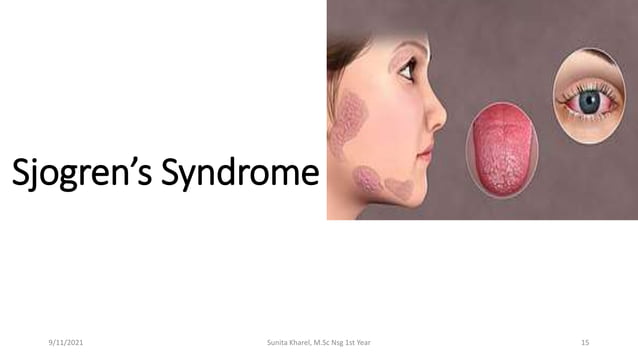 Autoimmune disease of bone | PPT