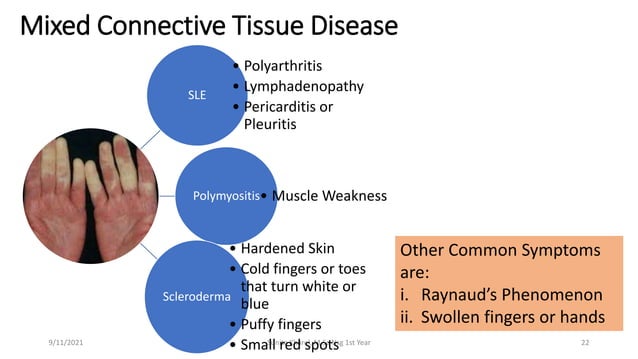 Autoimmune disease of bone | PPT
