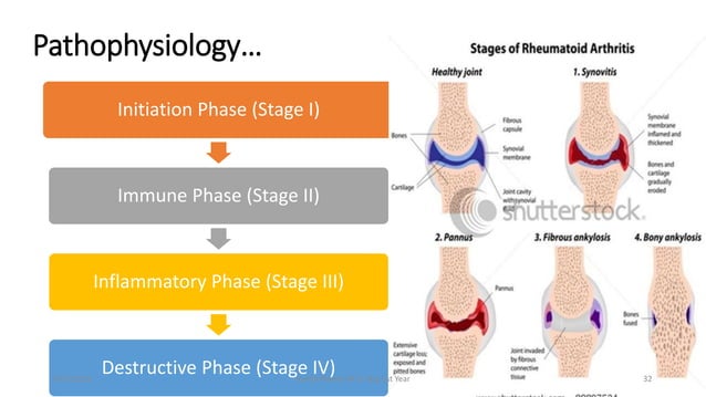 Autoimmune disease of bone | PPT