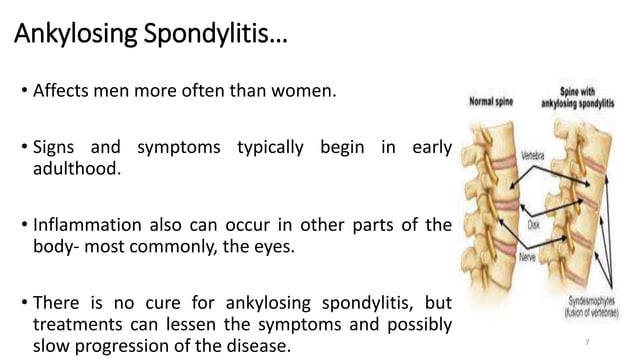 Autoimmune disease of bone | PPT