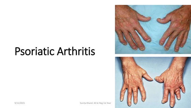 Autoimmune disease of bone | PPT