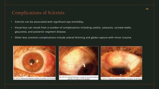 AUTOIMMUNE DISEASE OF EYE.presentation ppt | PPT