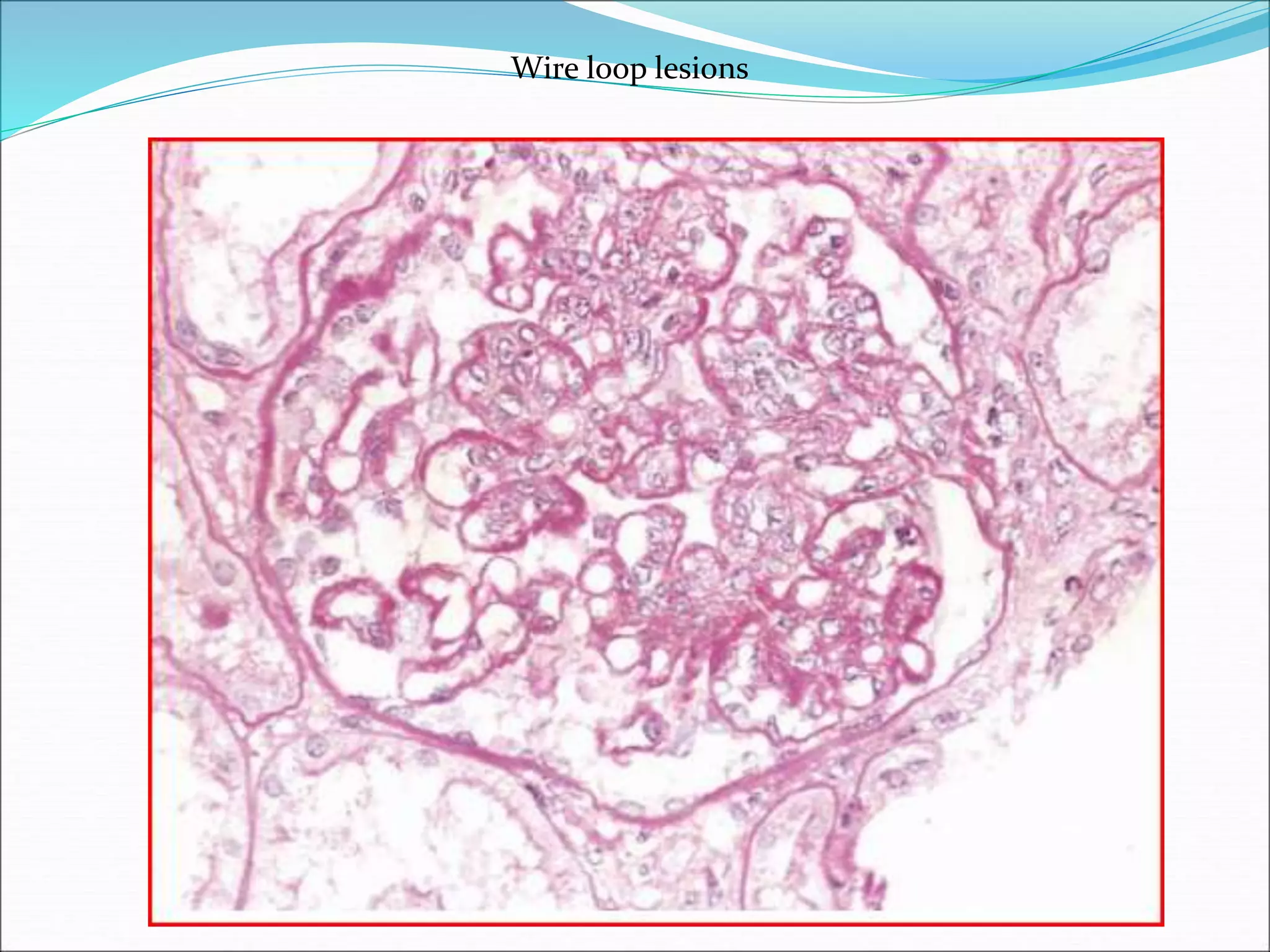 AUTOIMMUNE DISEASES.ppt