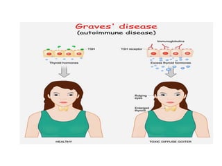 Autoimmune Diseases "Graves' Disease" | PPT