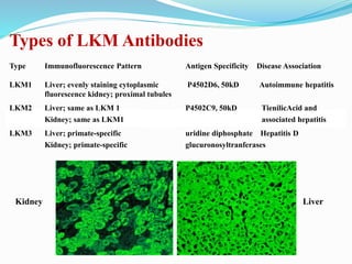 Autoimmune diseases diagnostic challenges | PPTX