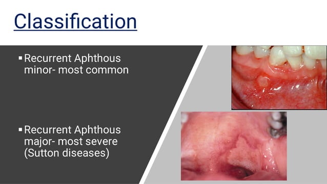 Autoimmune diseases of oral cavity | PDF | Ear, Nose and Throat ...