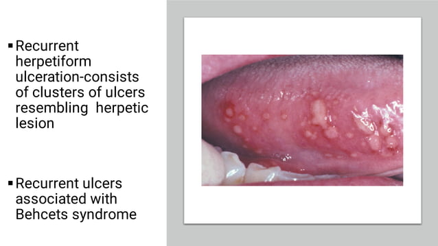 Autoimmune diseases of oral cavity | PDF | Ear, Nose and Throat ...