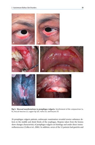 Autoimmune Diseases of the Skin_ Pathogenesis, Diagnosis, Management ...